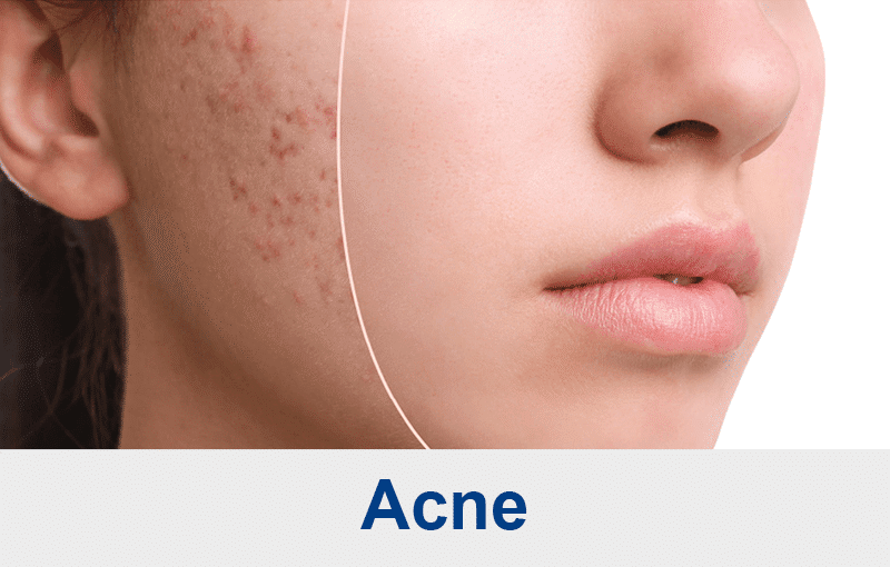 Buy Prescription Acne Medication Online - Acne Creams & Gels