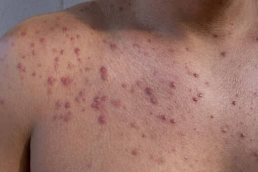 How To Get Rid Of Shoulder Acne: Effective Solutions And Tips ...